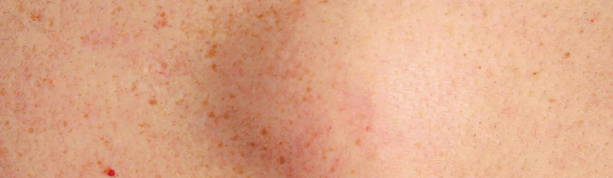 Quelle est la différence entre lipome et kyste ? | Dr Romain Aimard ...